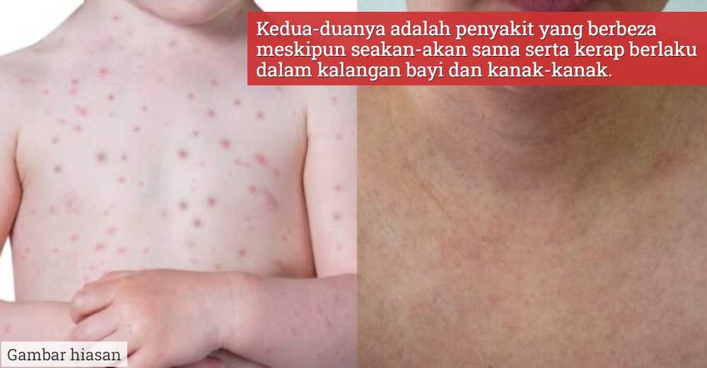 Cacar Air & Campak: Dua-dua Tumbuh Bintik Merah Pada Badan, Tapi Sama ...