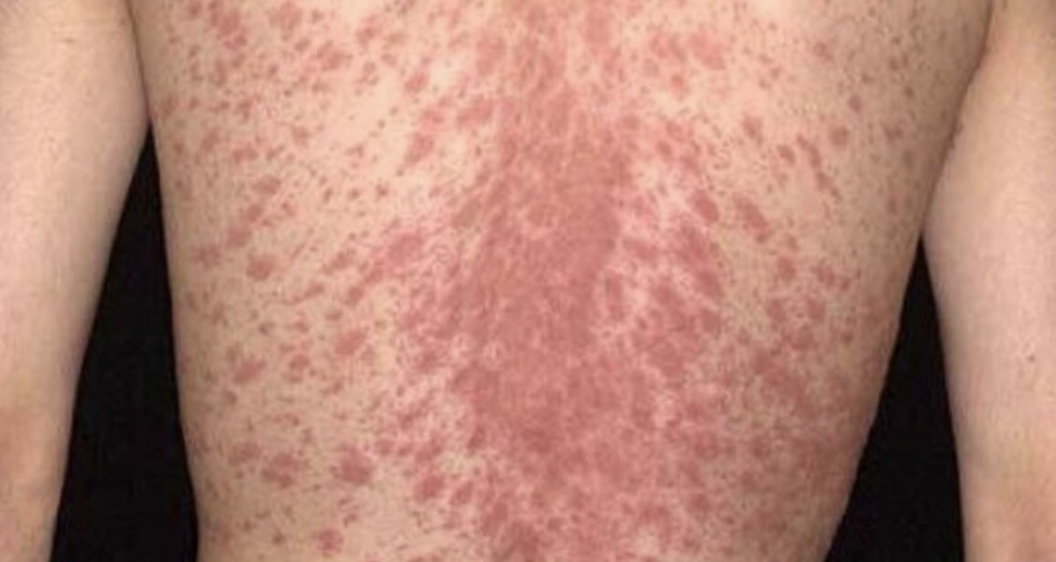 What is Pityriasis rosea?
