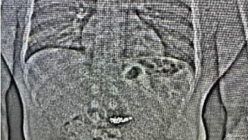 X-ray shows US$770,000 diamond earrings swallowed by theft suspect ...