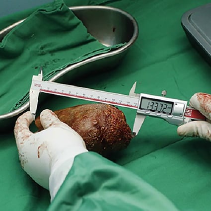 Sri Lanka doctors remove ‘world’s largest kidney stone’ – longer and ...