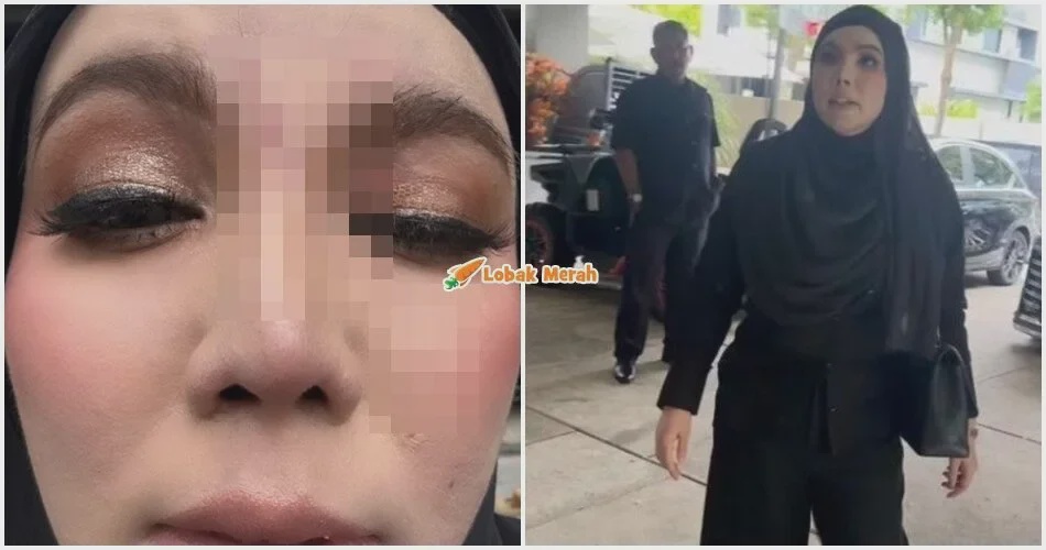 “Aku nak kutip barang aku jela bibik” – Cik Epal Tayang Kesan Calar Di Muka