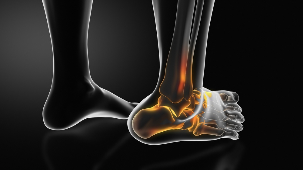 Twist, Snap, Ouch! What You Really Need to Know About Ankle Sprains
