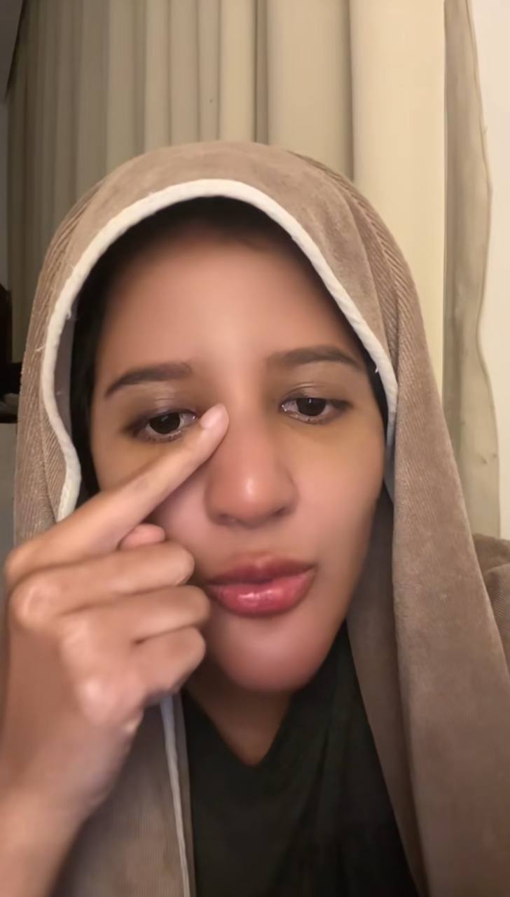 Hidung dan dagu jadi senget, Isteri Azlan Komeng akui terseksa buang ...