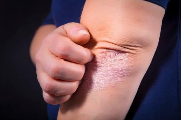 Cuba 5 Cara Ini Untuk Bersihkan Siku Hitam