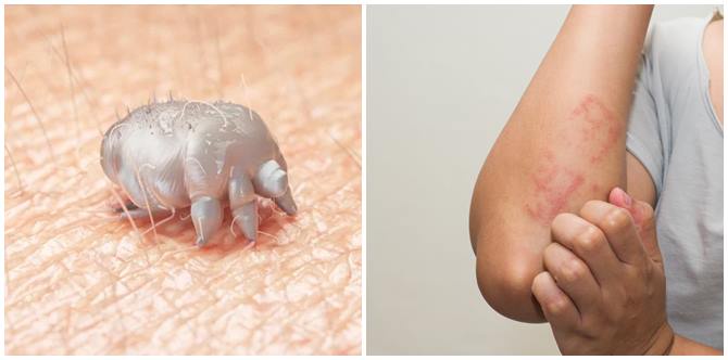 Elak Berkongsi Barang Peribadi, Kudis Buta Atau Scabies Boleh Berjangkit!