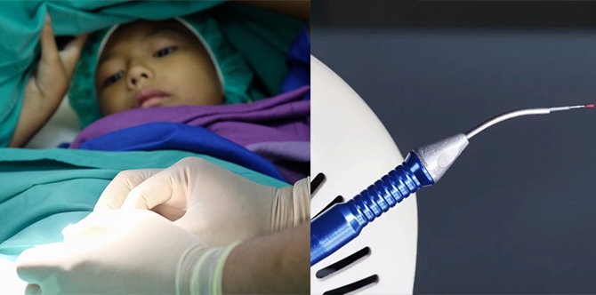 Sunat Laser vs Clamp, Kaedah Mana Lebih Baik?