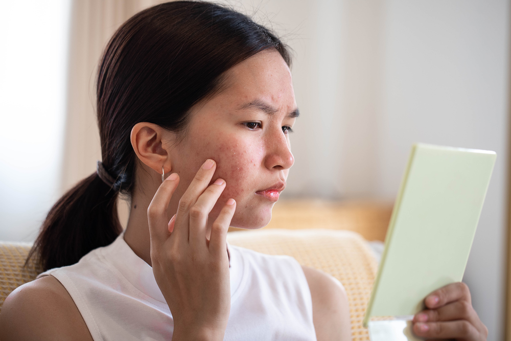 An expert says these are the best ways to get rid of acne scars and ...