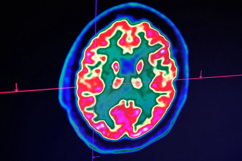 Doctor explains how doomscrolling and isolation age your brain