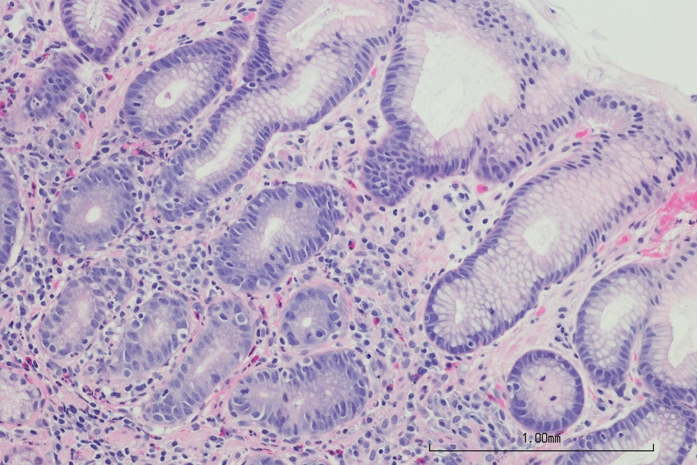 How a hated bacteria could protect the brain from Alzheimer’s disease