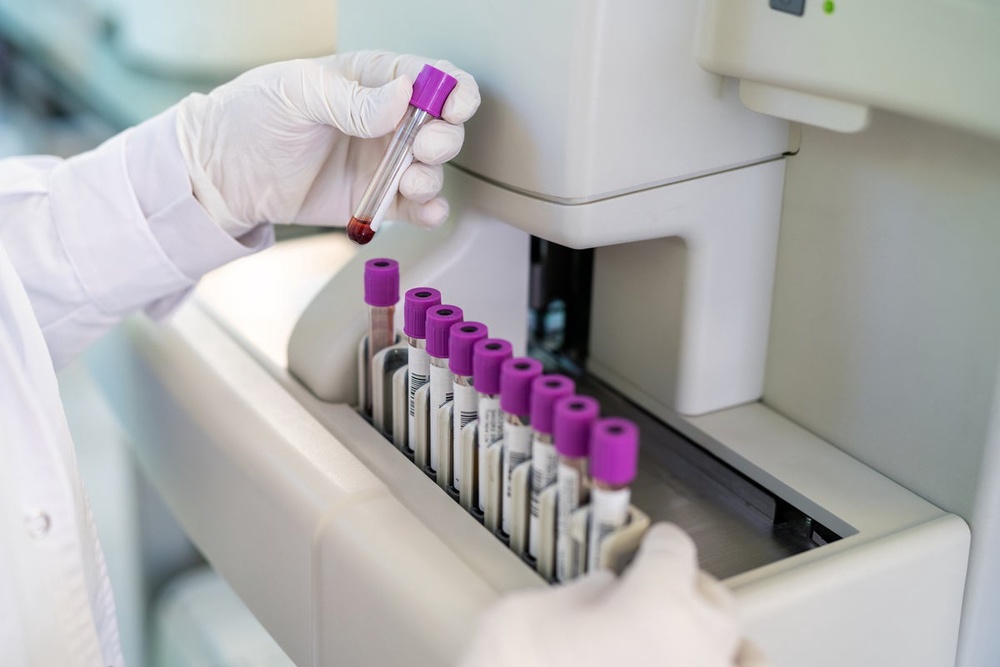 Innovative test could change how we diagnose ovarian cancer