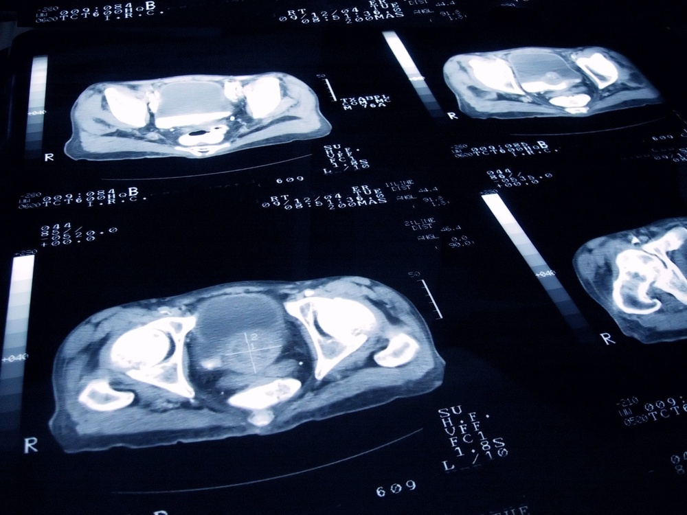 Thousands more Black men to benefit from prostate cancer screening ...