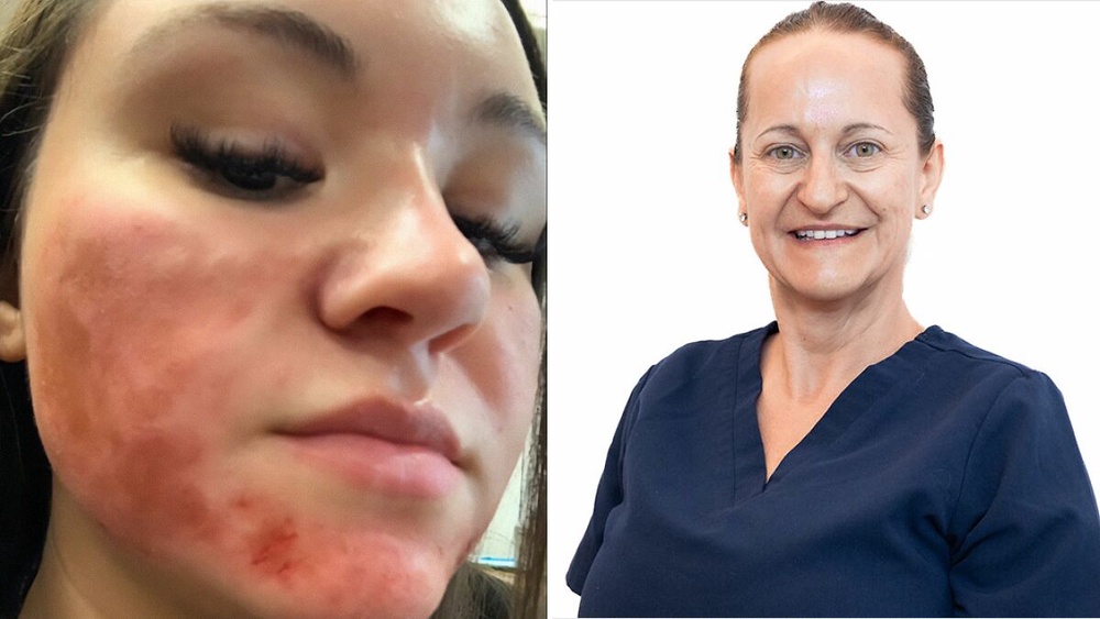 TikToker Suffers Chemical Facial Burns After Undergoing Microneedling ...