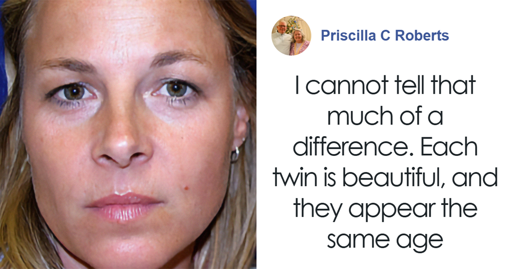 Viral Twin Study Comparing Botox To Natural Aging Leaves Netizens ...