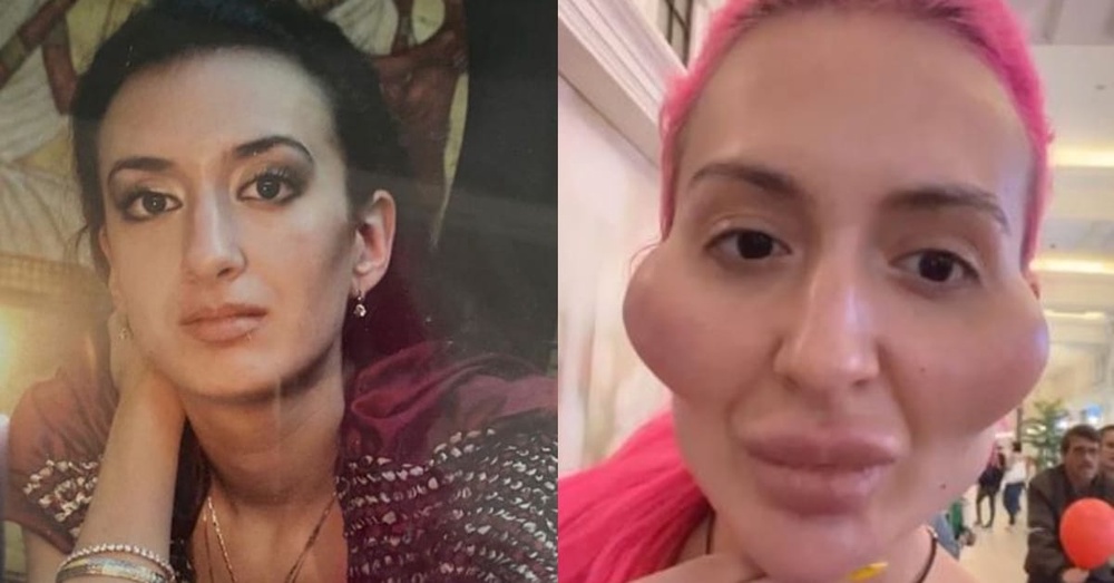 Berhabis Ribuan Pound Buat Muka, Model Terkenal Tak Kisah Pipi Besar ...