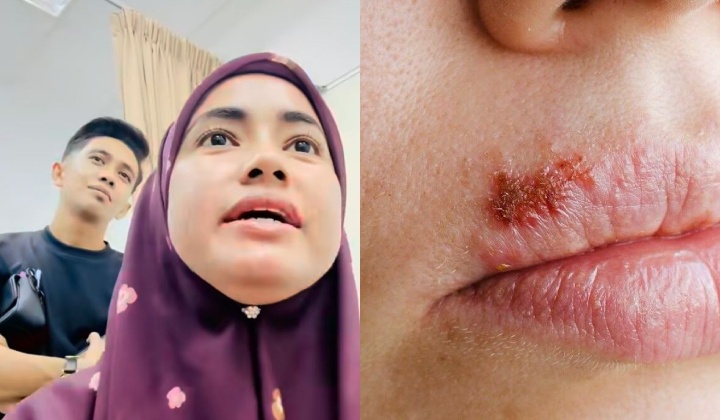 Entrepreneur “Kieda Crepe” Shares Her Oral Herpes Diagnosis – Doctor On Twitter Weighs In