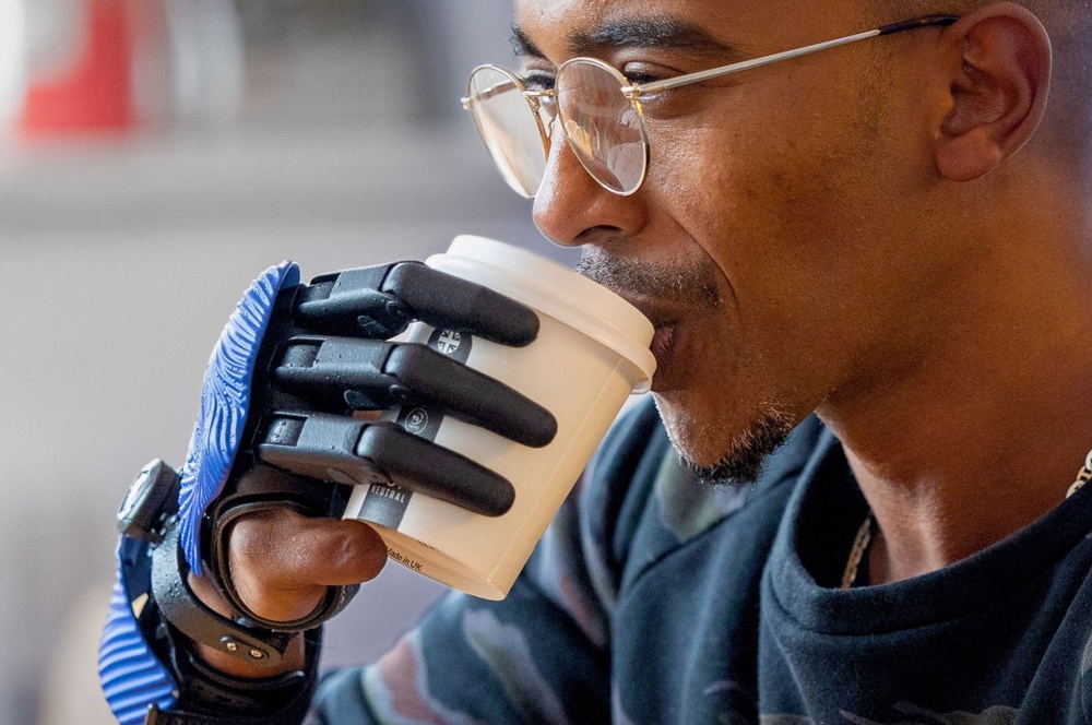 Man with amputated fingers since childhood gets life changing 3D ...